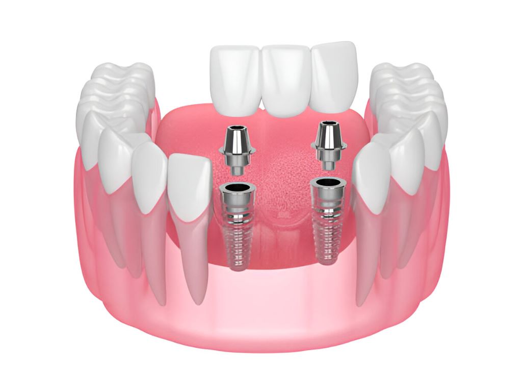 Multiple Tooth Implants in Tampa Near Riverview and Land O'Lakes